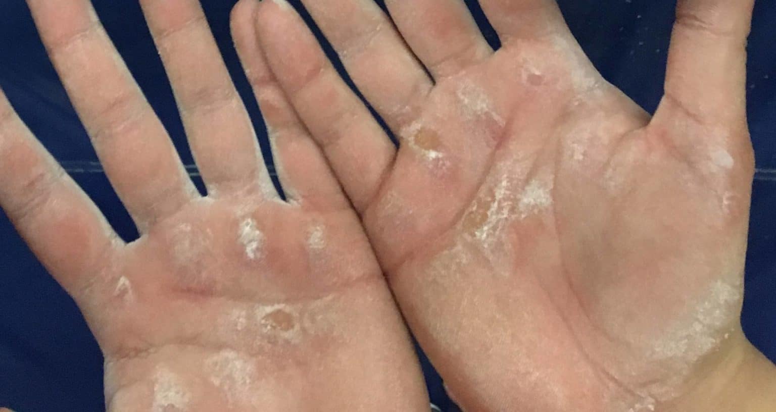 All About Gymnastics Rips: Causes, Preventing, Healing